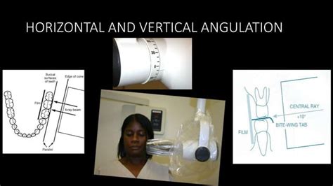 Dental Radiology Bitewing Radiography Copypptx