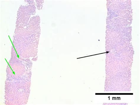 Primary Sclerosing Cholangitis Libre Pathology