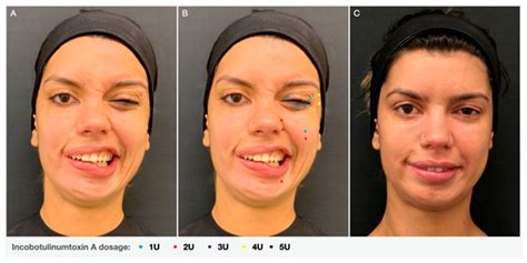 Botulinum Toxin Type A To Improve Facial Symmetry In Facial Palsy A