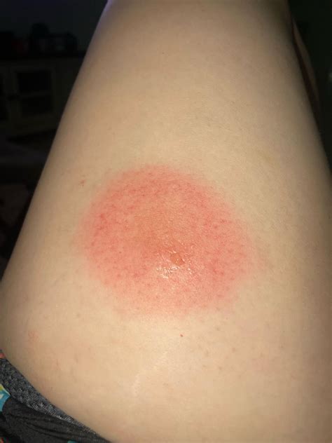 Circular Rash On Leg Rdermatologyquestions