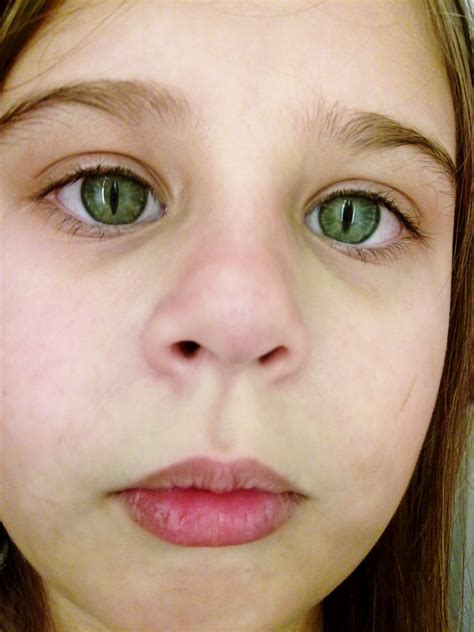 Síndrome De Coloboma O Pupilas De Gato Info Taringa
