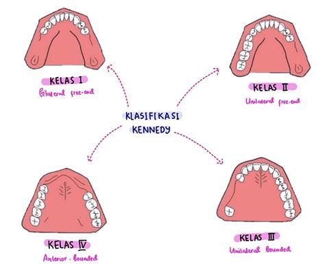Klasifikasi Kennedy Info Drg