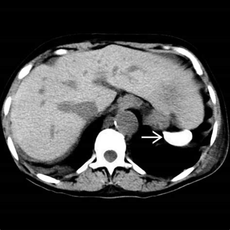 Sickle Cell Anemia Clinical Gate