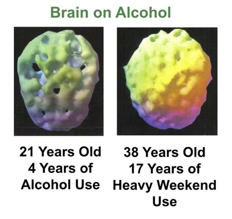 Alcohol And Depression Brain Scan