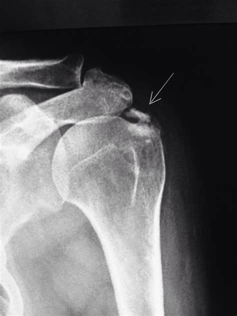 Tendinitis Calcificada Y Osteofito Cirugía De Hombro Y Rodilla Blog