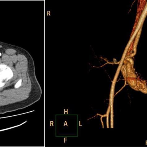 Computed Tomographic Angiography Showed A Large Pelvic Arteriovenous Download Scientific