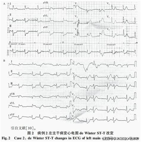 對心電圖de Winter St T改變的思考