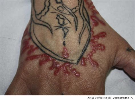 Top 114 Tattoo Skin Allergy