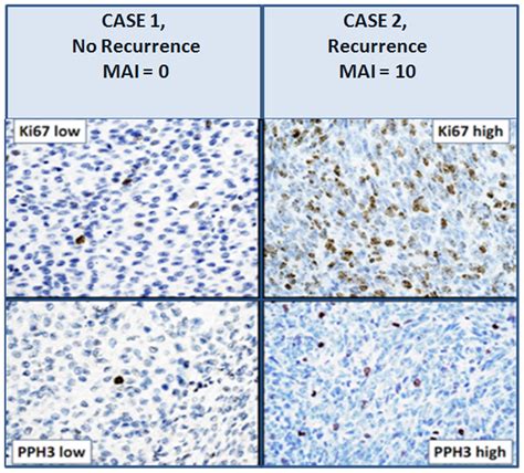 examples of endometrial stroma sarcomas showing parallel ki 67 and pph3