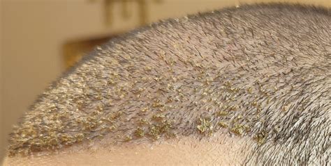 Why Are My Scabs So Slow To Go Away By Day 12 Post Fue Hair