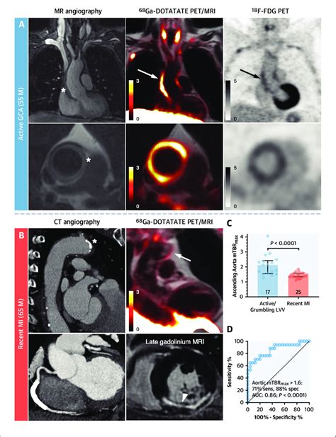 Vasculitis Vs Atherosclerotic Inflammation Download Scientific Diagram