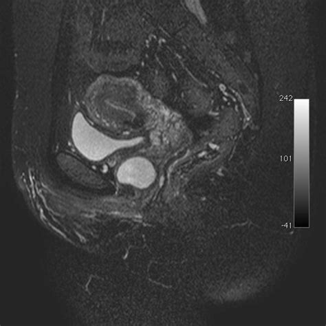 Urethral Diverticulum Mri Epos™