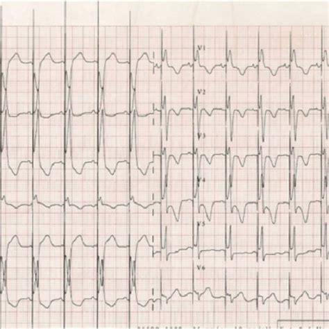 Pdf Transvenous Dual Chamber Pacemaker After Paediatric Heart Transplantation Using Left