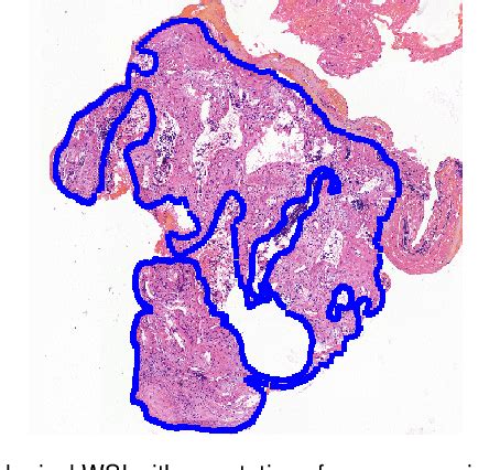 Figure From Deep Learning Methods For Lung Cancer Segmentation In Whole Slide Histopathology