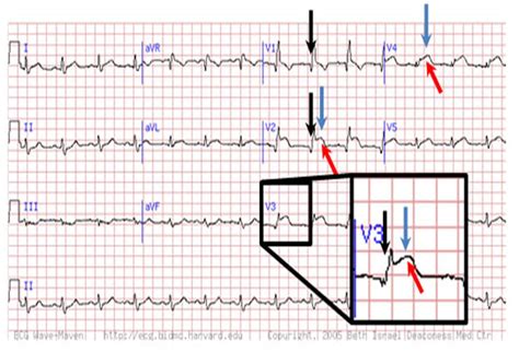 Infarction Ekg Septal Infarct