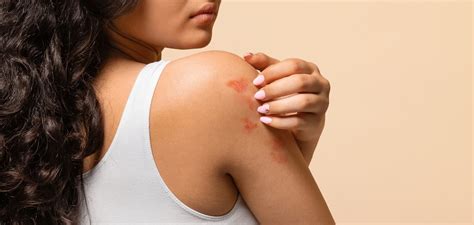 Whats The Difference Between Eczema And Psoriasis