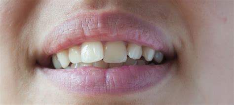 Crooked Teeth Dentist Putney And Wandsworth
