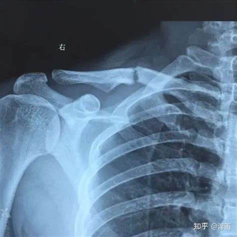 骨折知多少（八）锁骨骨折 知乎