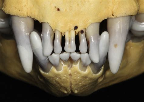 Fused Maxillary First Incisor Teeth In A Young Adult Female Specimen