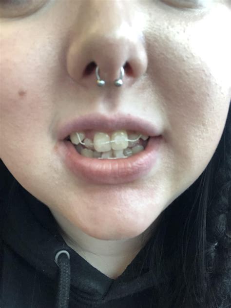 How Bad Are My Teeth After Braces I Got Them Removed Today And Couldn