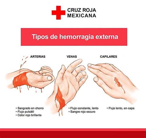 Conoce Los Tipos De Hemorragia Externa Y Como Actuar Ante Flickr Porn