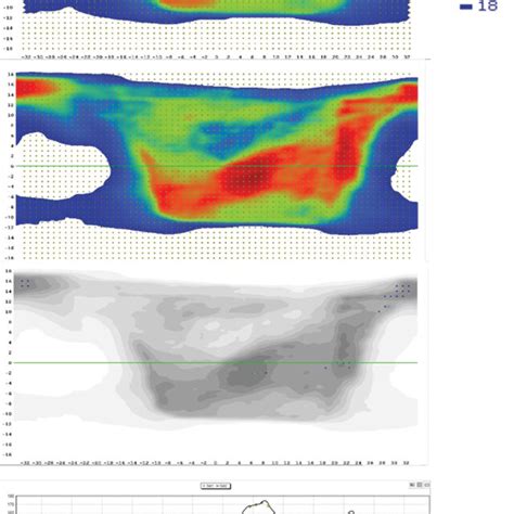 Tangent Breast Plan With Dynamically Flattened Beam On Arccheck