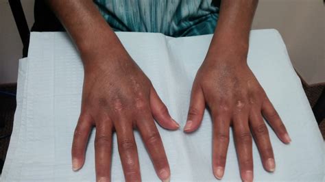 Dr John Cush On Twitter Study Of 100 Korean Systemic Sclerosis Pts