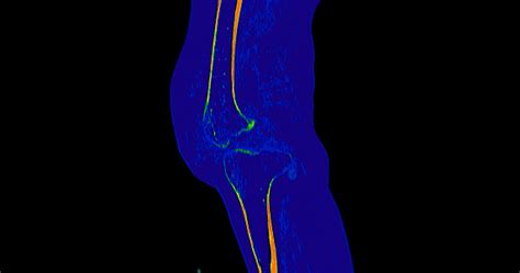 Gambar Ct Knee Atau Ct Scan Dari Tampilan Sagital Sendi Lutut Foto Stok