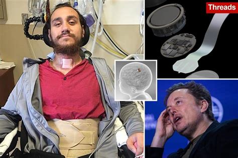 Elon Musks Neuralink Chip Suffers Unexpected Setback In First In Human