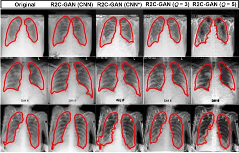 Segmented Lung Regions Are Illustrated When The U Net Model Is Applied