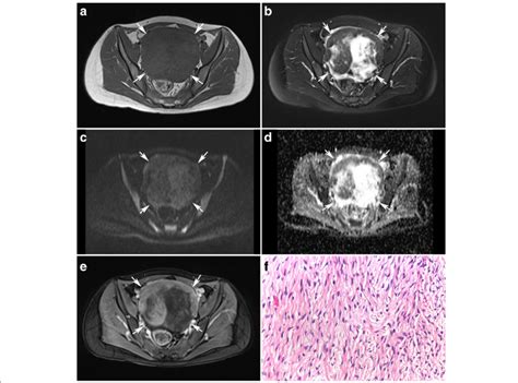 Ovarian Thecoma Ultrasound