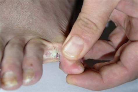 Athletes Foot Nhs