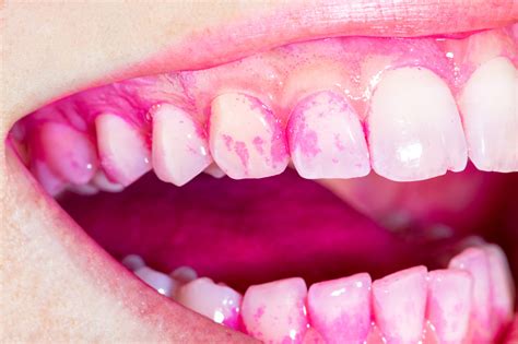 How Long Does It Take For Gums To Heal After Deep Cleaning