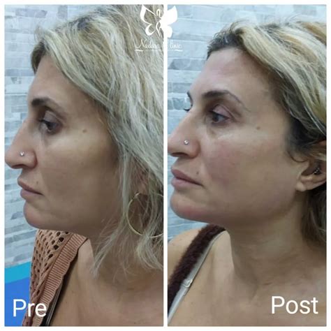 Hifu Face Lift Hifu Face Lift Freshness Center For Dermatology And