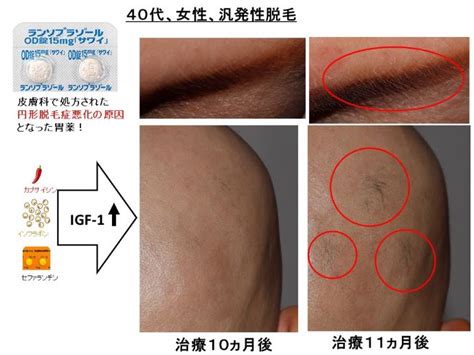 汎発性脱毛の患者さんの声；”（治療中、急に産毛と眉毛が生えてきて）すごい！” 患者様からの声・メディア掲載・クリニックからのお知らせ