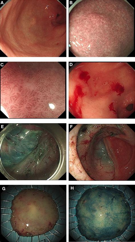 Frontiers Breast Cancer Metastases To The Stomach With Endoscopic