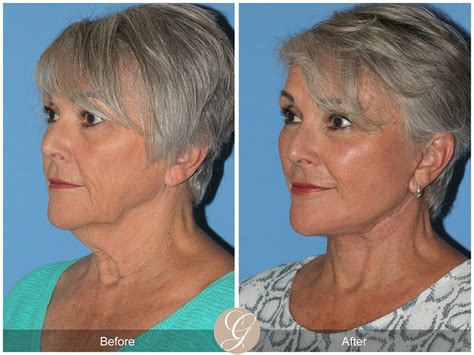 Deep Plane Facelift Newport Beach Dr Kevin Sadati Plastic Surgery