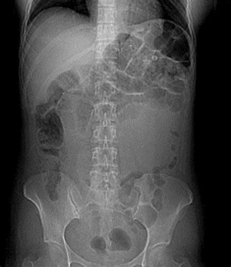 Target Sign Intussusception X Ray The Appearance Is Generated By