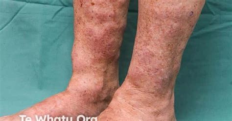 Dermnet® Pretibial Myxoedema Image