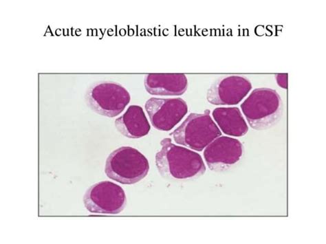 Cerebrospinal Fluid Csf Examination Under Microscope Ppt