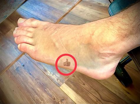 Matthew Shomper On Linkedin Christmas Fracture Orthopedic