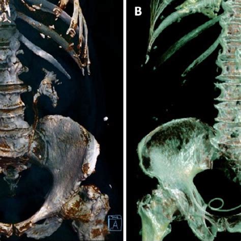 Three Dimensional Reconstruction Based On The Non Contrast Ct Download Scientific Diagram
