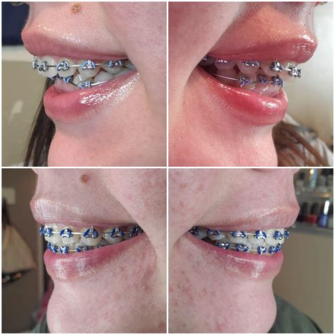 Before And After Braces Overbite Profile