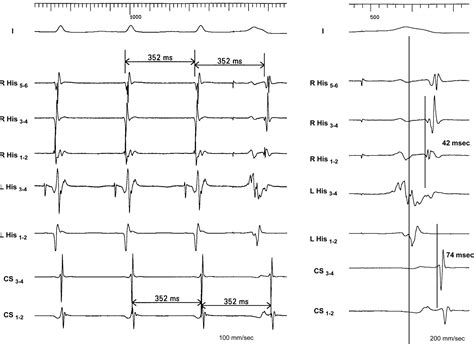 Atrioventricular Nodal Reentry Tachycardia AVNRT ECG 43 OFF