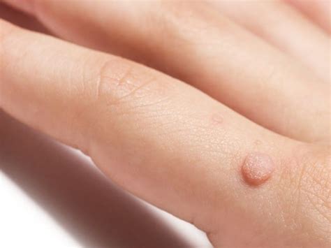 Common Warts And How Theyre Treated Dermatology Treatment 55 Off