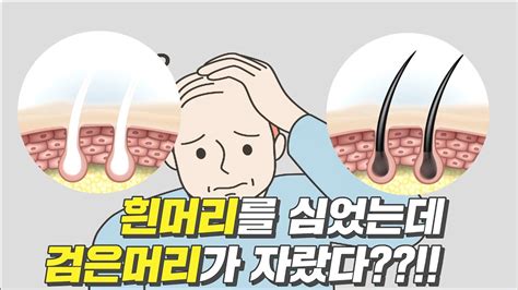 모발이식 흰머리를 이식했는데 검은머리가 자랐습니다 왜 그런가요 Youtube