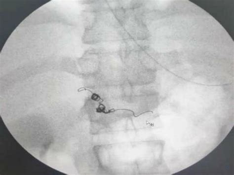 Post Embolization Angiogram Shows Coils Within The Aneurysm Sac With