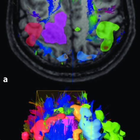 Dti Fibre Tractography And Fmri Activation A Overlaid Onto An Axial