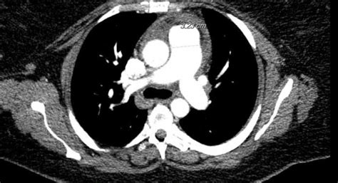 Role Of Pocus In The Diagnosis Of Acute Pericarditis Ultrasound