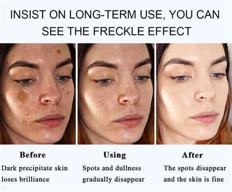 Dark Spot Corrector Cream Fade Age Spot Discoloration Sun Spot Removal